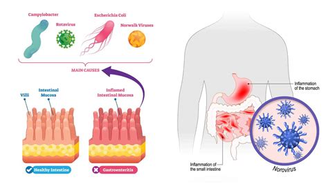 Viral Gastroenteritis