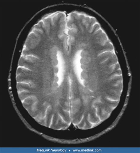 Periventricular Nodular Heterotopia Pvnh Medlink Neurology