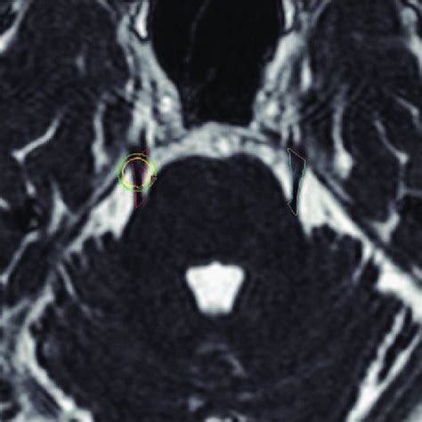 Pdf Trigeminal Nerve Asymmetry In Classic Trigeminal Neuralgia