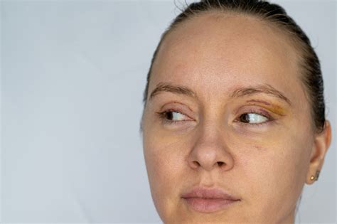 성형 수술 안검 성형술 눈에 보이는 눈 상처 부은 눈 주머니 부은 피부 봉합사 및 타박상 눈꺼풀 후 여성 얼굴 회복 과도한 피부