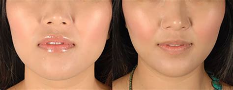Masseter Botox Dr Areeb Anwar