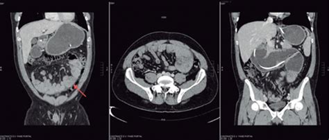 Tc De Abdomen Y Pelvis Donde Es Posible Apreciar El Llamado Capullo