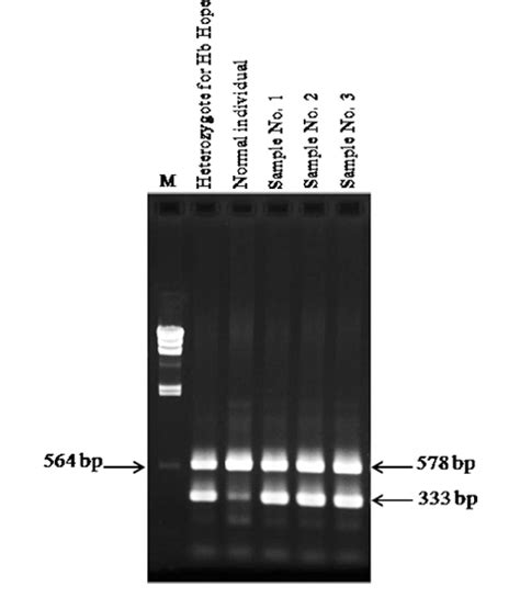 Amplification Refractory Mutation System Arms For Identifying Of Hb Download Scientific