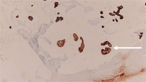 Figure 8 From Intrabiliary Metastasis Of Colorectal Mucinous