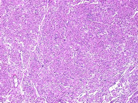 Chromophobe Renal Cell Carcinoma Mimicking Oncocytoma Permanent Of