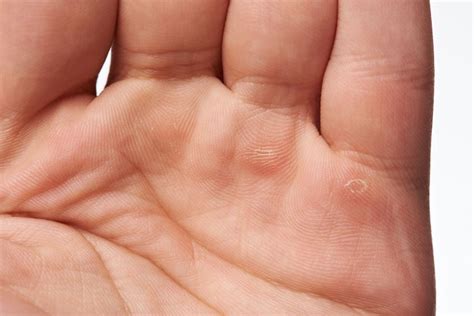 How To Remove Calluses Naturally From Hands Feet Power Life