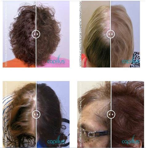 Hair Loss Cure For Women Fashionnfreak