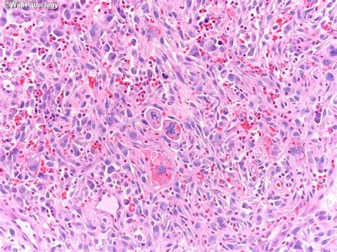 Sarcomatoid Carcinoma