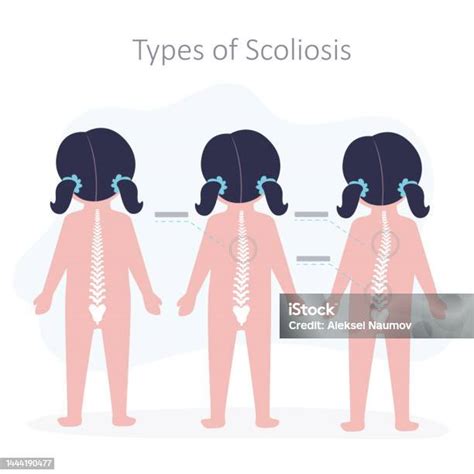 다양한 유형의 척추측만증이 있는 교육 포스터 근골격계 장애가있는 어린이 다양한 정도의 척추 측만증의 예 척추 곡률 개념 뒷모습