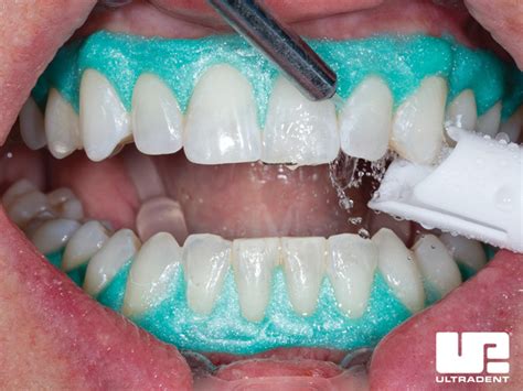 Ultradent Opalescence Boost Teeth Whitening Clinical Research Dental