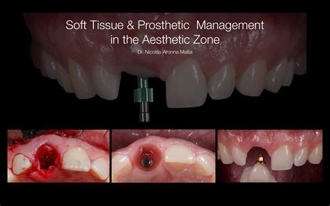 Implant Placement In The Esthetic Zone Protection Zone Concept