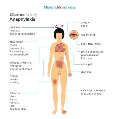 Anaphylaxis Signs Causes And Treatment Artofit