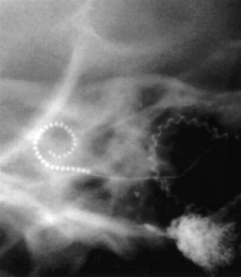Case 1 Plain X Ray Reverse Stenver View Showing Cochlear Implant