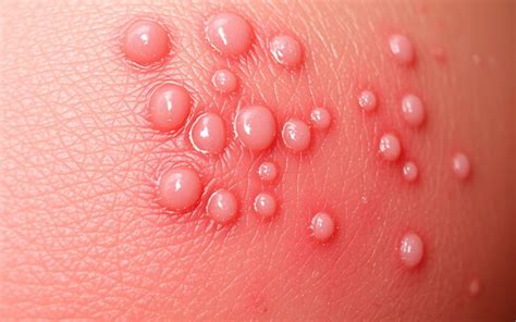 What Does Herpes Look Like Identifying Symptoms With Photos