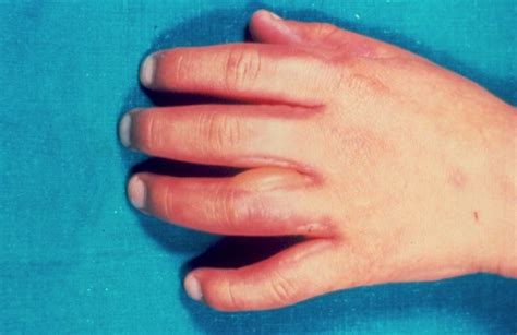 Hogweed Eye Injuries