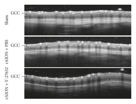 Cross Sectional Oct Images Displaying Gcc Thickness At 2 Days And 28
