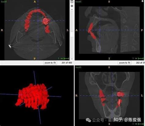 Sts3d2023——sts 基于3d Cbct的牙齿分割任务 知乎