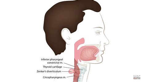 Zenkers Diverticulum Esophagus Transcervical Repair Of