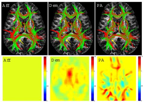 Top Row 3d Renderings Of The Registered Tracts Of A Subject In Green Download Scientific