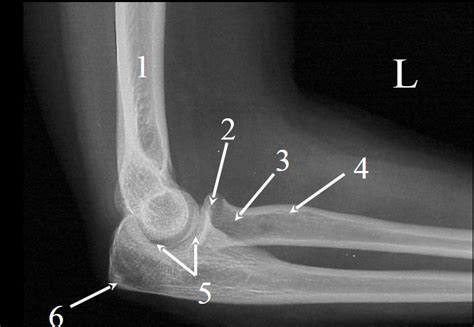 Lateral Elbow Anatomy Diagram Quizlet