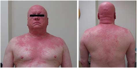 A Photodistributed Erythematous Eczematous Eruption Affecting The Face
