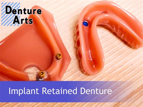 Implant Retained Locator Bar Overdentures — Denture Arts Of Pocatello