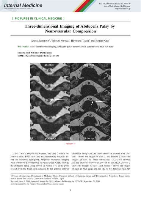 Pdf Three Dimensional Imaging Of Abducens Palsy By Neurovascular Compression