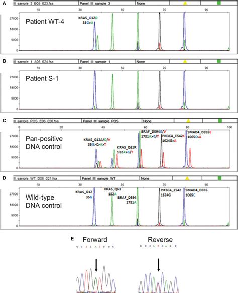Kras G12d Mutation In Human Wt Dna Was Extracted From Formalin Fixed Download Scientific