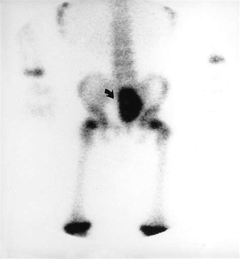 Psoas Abscess Pediatric Pediatrics Orthobullets