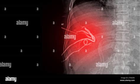 Percutaneous Transhepatic Biliary Drainage Ptbd Is A Medical Procedure Used To Treat Bile Duct