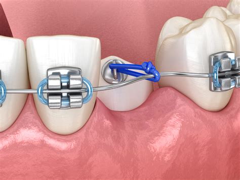 Taking Steps To Bracket Your Impacted Tooth