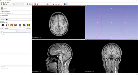 Visualizing MRI CT Scans In Mixed Reality VR AR Part 1