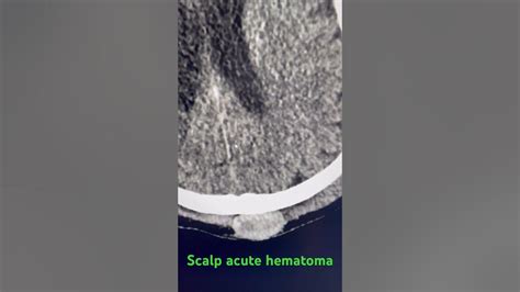 Acute Scalp Hematoma Nhs Radiology Youtube