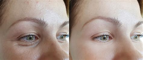 Plexr For Non Surgical Blepharoplasty Skin Medical