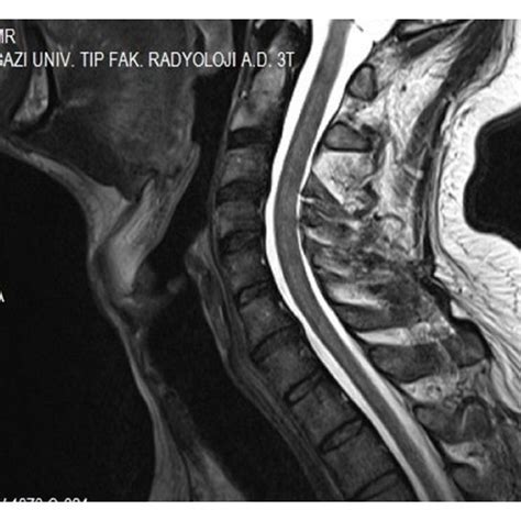 A Normal Cervical Mri T2 Weighted Sagittal Section B