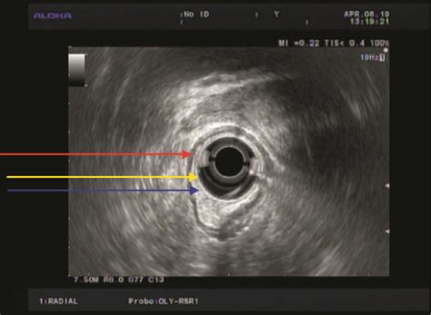 Rectal Endoscopic Ultrasound Eus Showing A Localized Hypoechoic Download Scientific Diagram