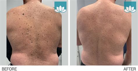 Seborrheic Keratosis Treatment In South Miami