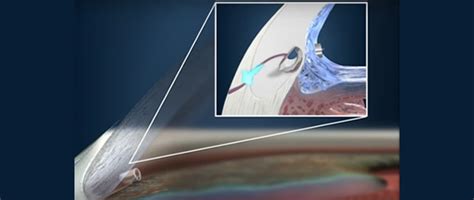 Minimally Invasive Glaucoma Surgery Istent Northbrook