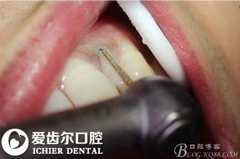 Cadcam瓷贴面快速修复先天性过小牙案例 武汉牙医嵇强的博客 Kq88口腔博客