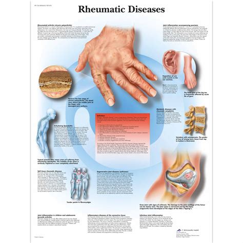 Rheumatic Diseases Chart Sem Trainers