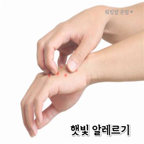 아기 햇빛 알레르기 광과민증 검사 얼굴 팔 두드러기 증상 재채기 땀띠 수포 옷 네이버 블로그