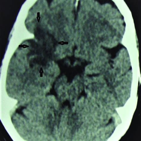 Pdf Hyper Dense Artery Sign Is An Extremely Valuable Marker Of Middle Cerebral Artery