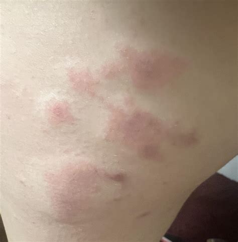 Does Anyone Know What This Rash Is Its Growing On The Back Of My