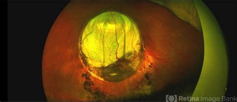 Coloboma Retina Image Bank