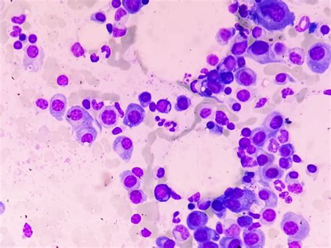 Understanding Adverse Events With Bcma Non Bcma Targeting Bispecific