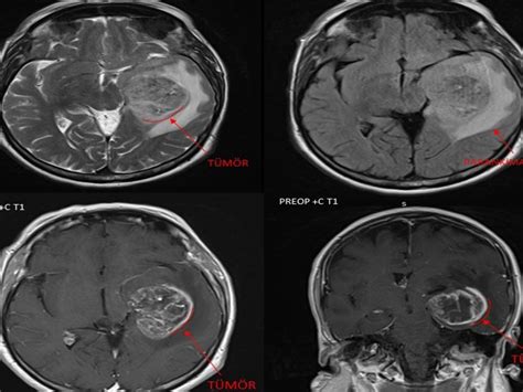 გლიალური სიმსივნეები ძვლის თავის ტვინის სიმსივნეები მეტასტაზი Prof Dr Hakan Emmez