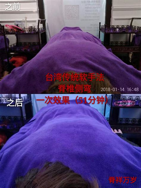 Scoliosis Successful Cases 广东脊祥万岁健康管理有限公司