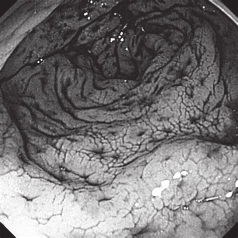 Colonoscopy Reveals Mild Mucosal Edema And Erosion Of Sigmoid Colon Download Scientific Diagram