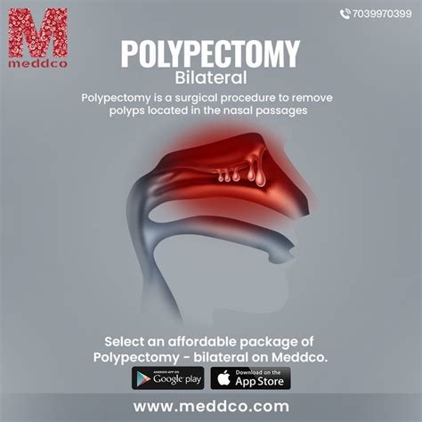Polypectomy Bilateral