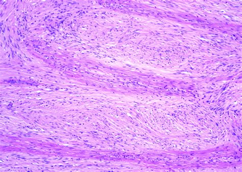 Gastrointestinal Schwannomas CT Features With Clinicopathologic